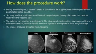 Mammography | PPTX