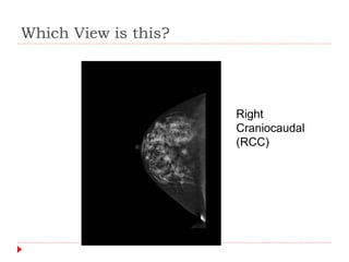 A Brief Overview of Mammography | PPTX