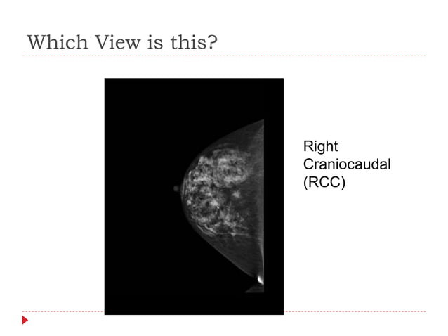 A Brief Overview of Mammography | PPTX