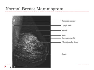 A Brief Overview of Mammography | PPTX