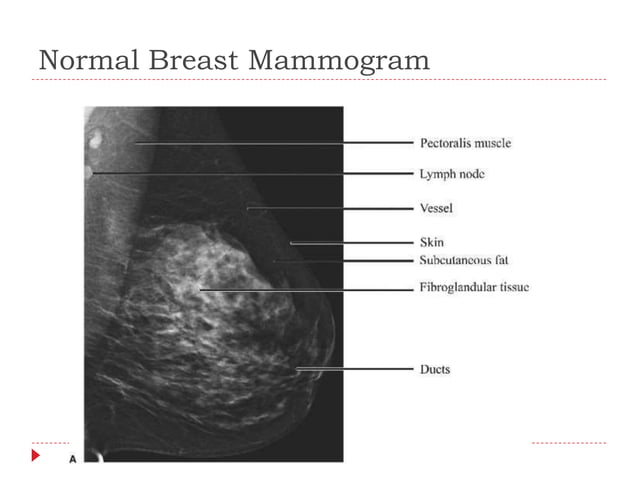 A Brief Overview of Mammography | PPTX