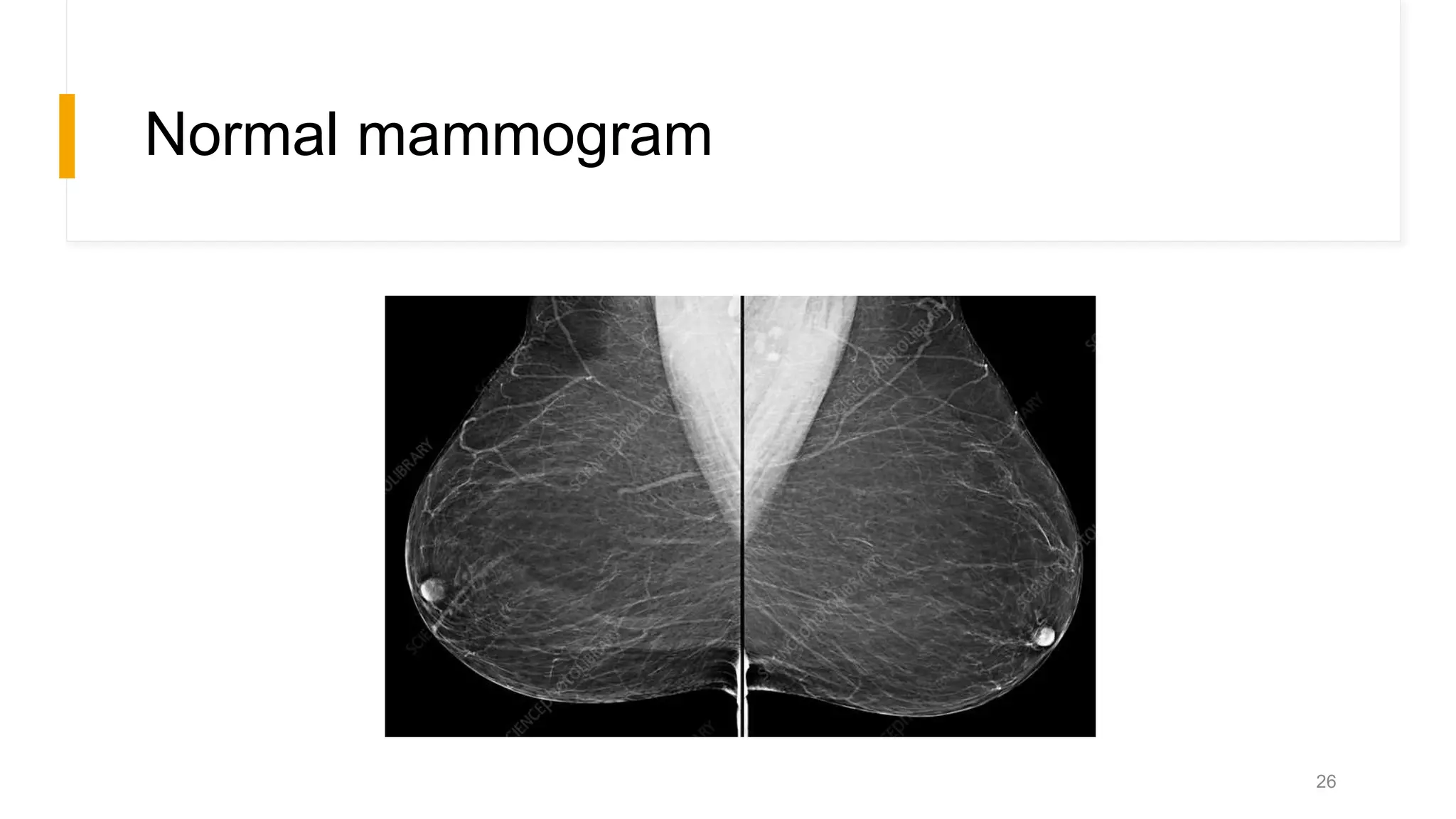 Mammography | PPTX