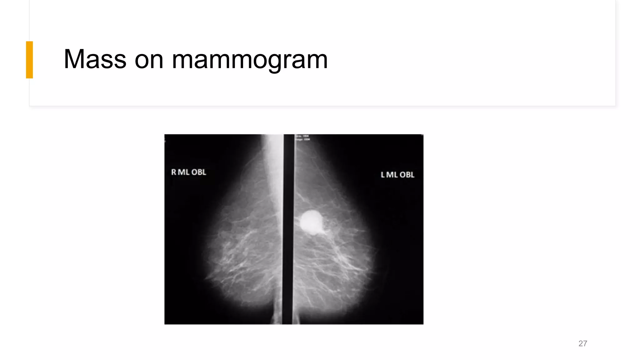 Mammography | PPTX