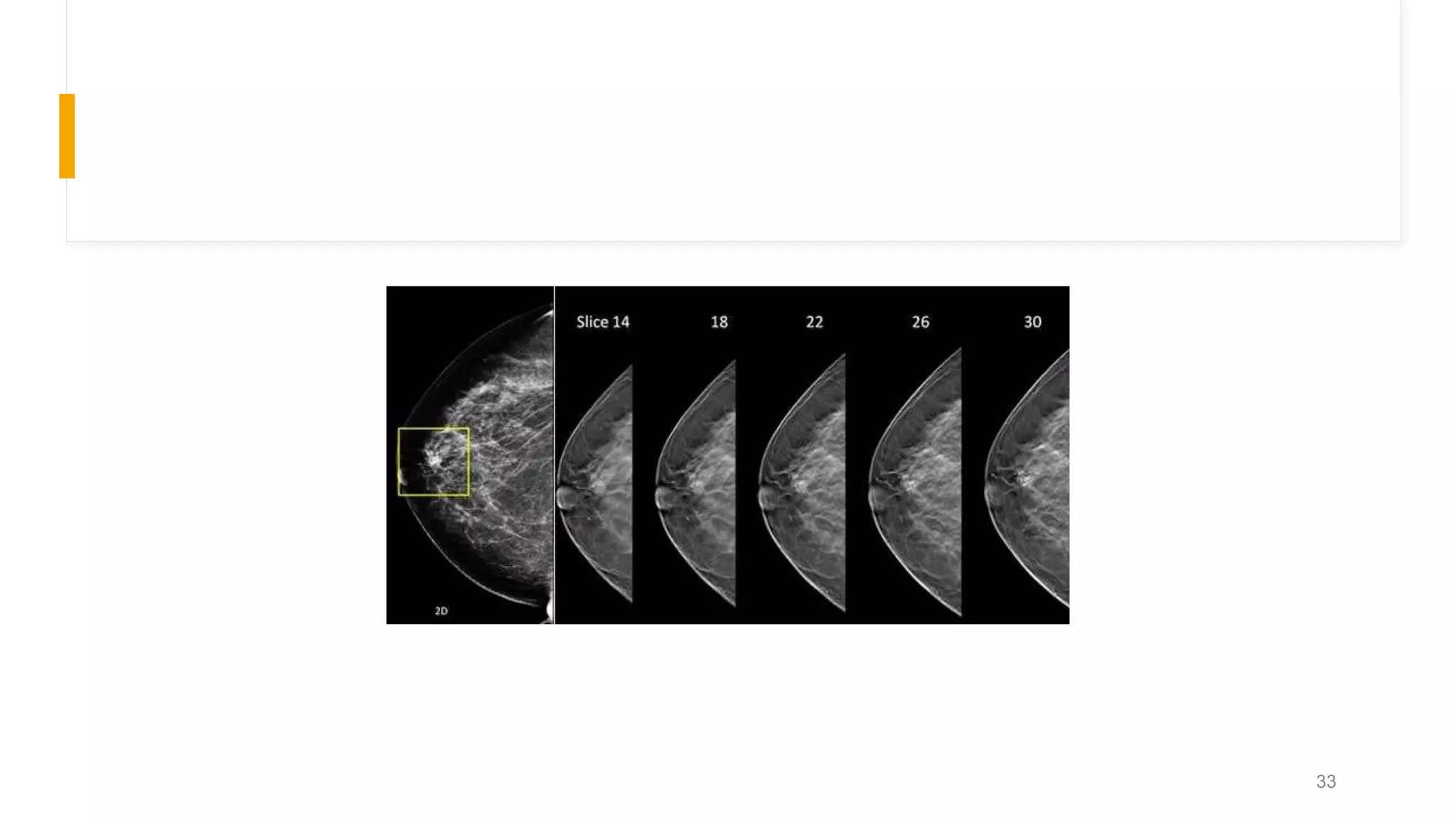 Mammography | PPTX