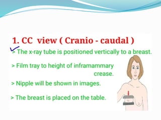 Mammography: X-Ray Tube Design, Image Acquisition Techniques, and ...