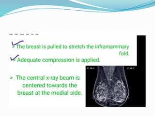 Mammography: X-Ray Tube Design, Image Acquisition Techniques, and ...