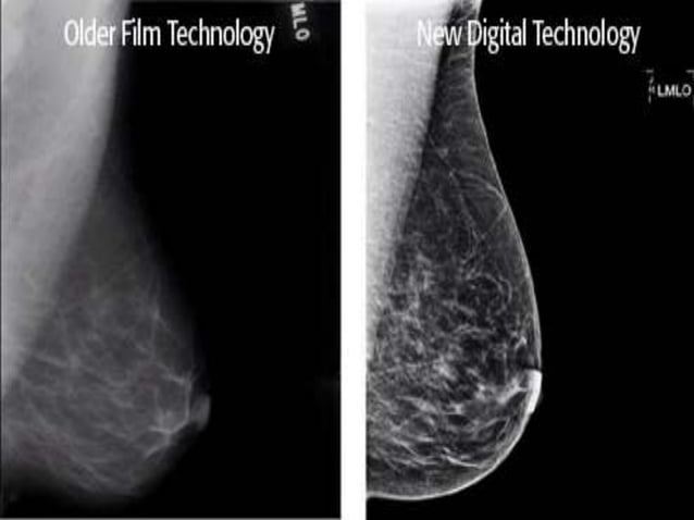 Mammography physics and technique | PPTX