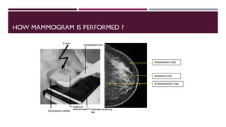 Mammography | PDF