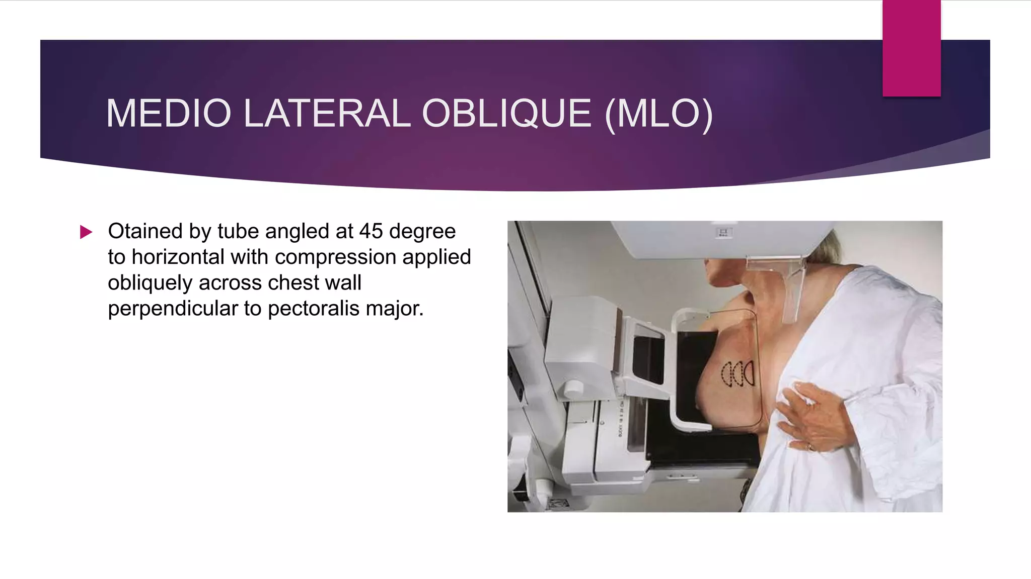 Mammography and recent advances dr avinash | PPTX