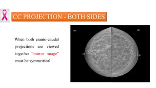 MAMMOGRAPHY VIEWS .ppt