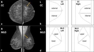 MAMMOGRAPHY VIEWS .ppt