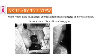 MAMMOGRAPHY VIEWS .ppt