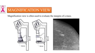 MAMMOGRAPHY VIEWS .ppt