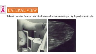 MAMMOGRAPHY VIEWS .ppt