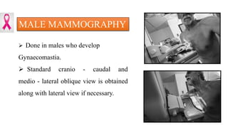 MAMMOGRAPHY VIEWS .ppt