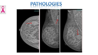 MAMMOGRAPHY VIEWS .ppt
