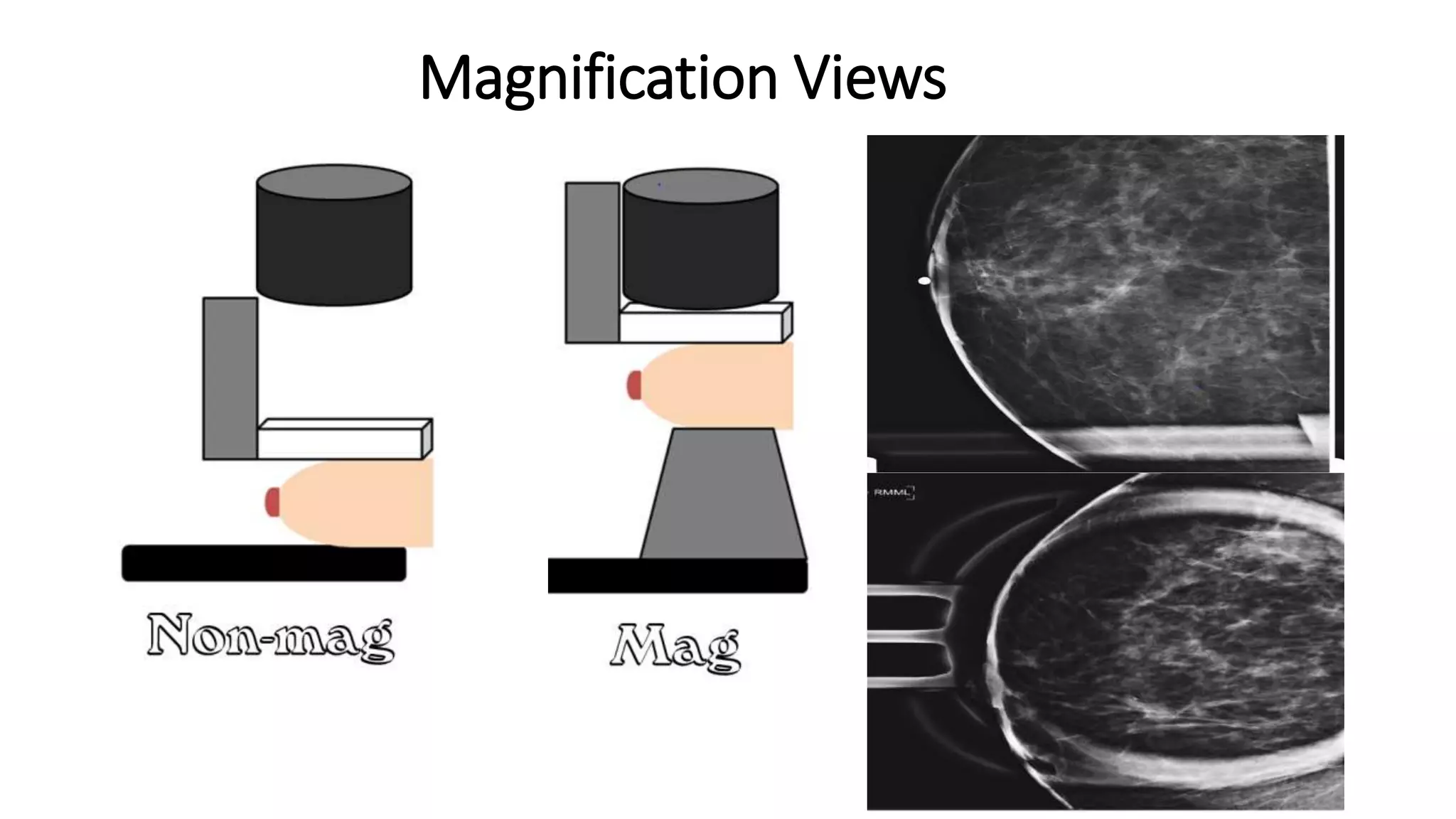 Mammography Positioning Technique for Additional Views | PPTX