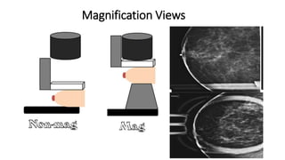 Mammography Positioning Technique for Additional Views | PPTX