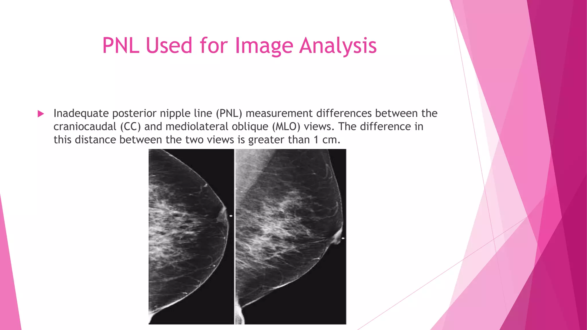 Mammography positioning technique for Cranio Caudal (CC) | PPTX
