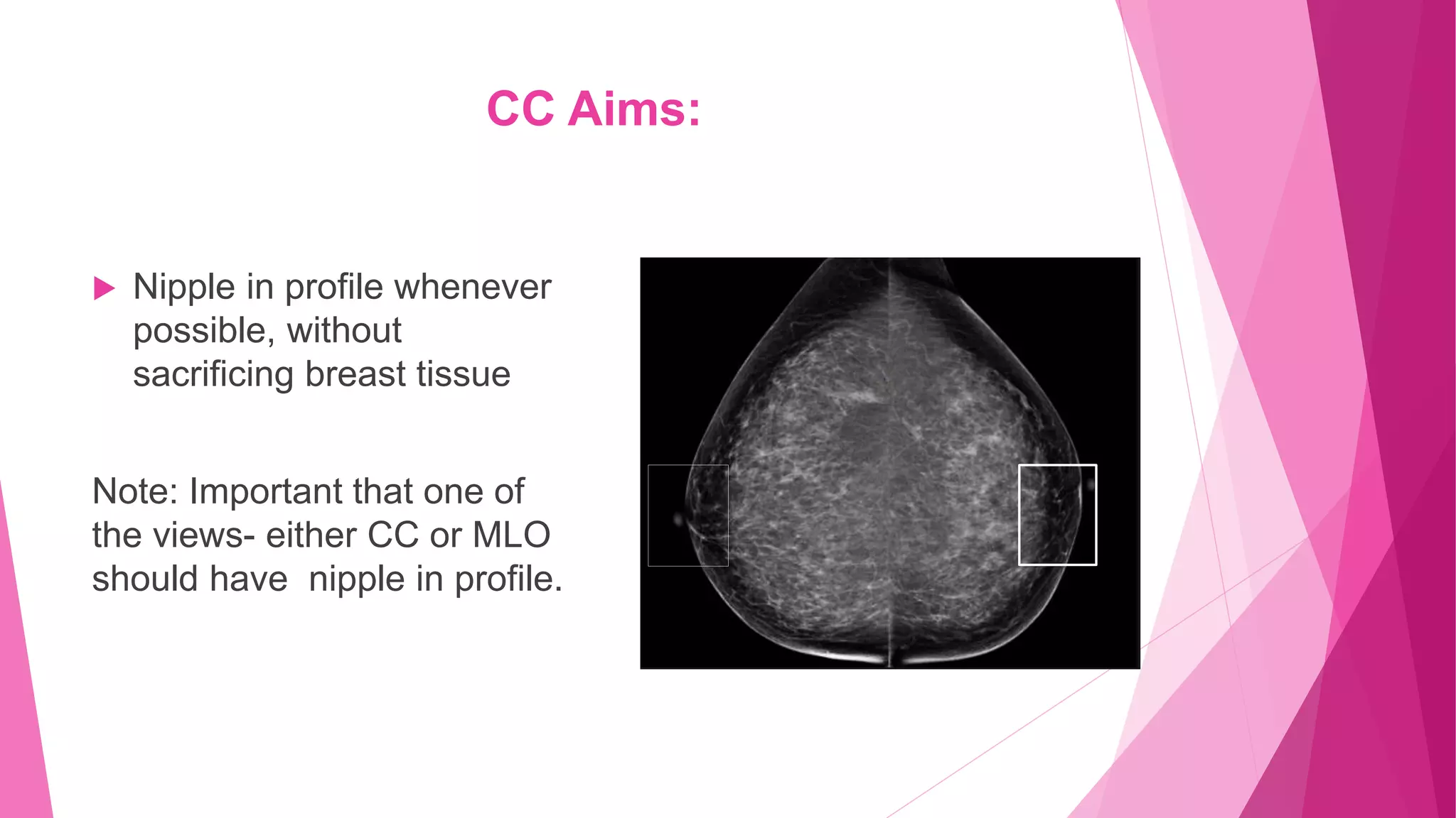 Mammography positioning technique for Cranio Caudal (CC) | PPTX