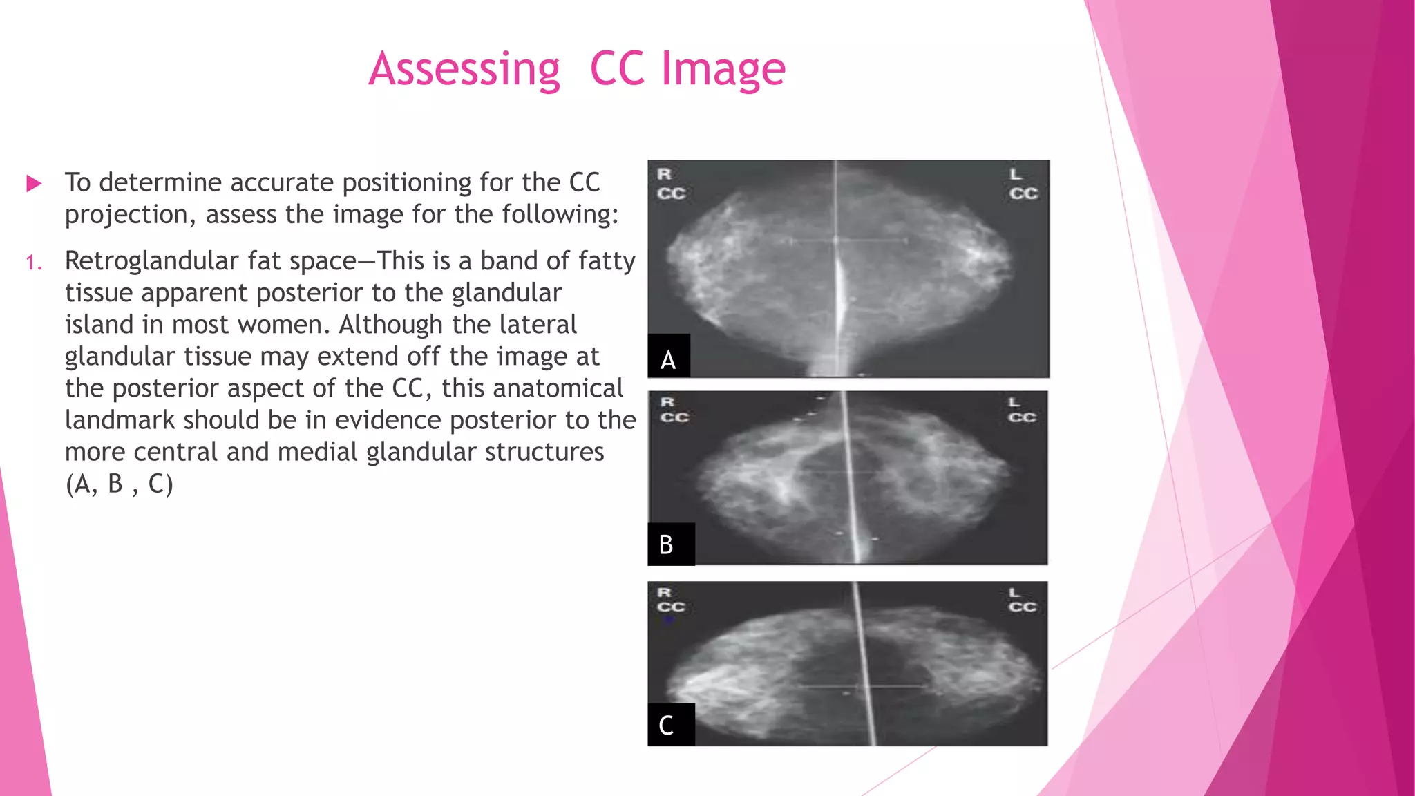 Mammography positioning technique for Cranio Caudal (CC) | PPTX