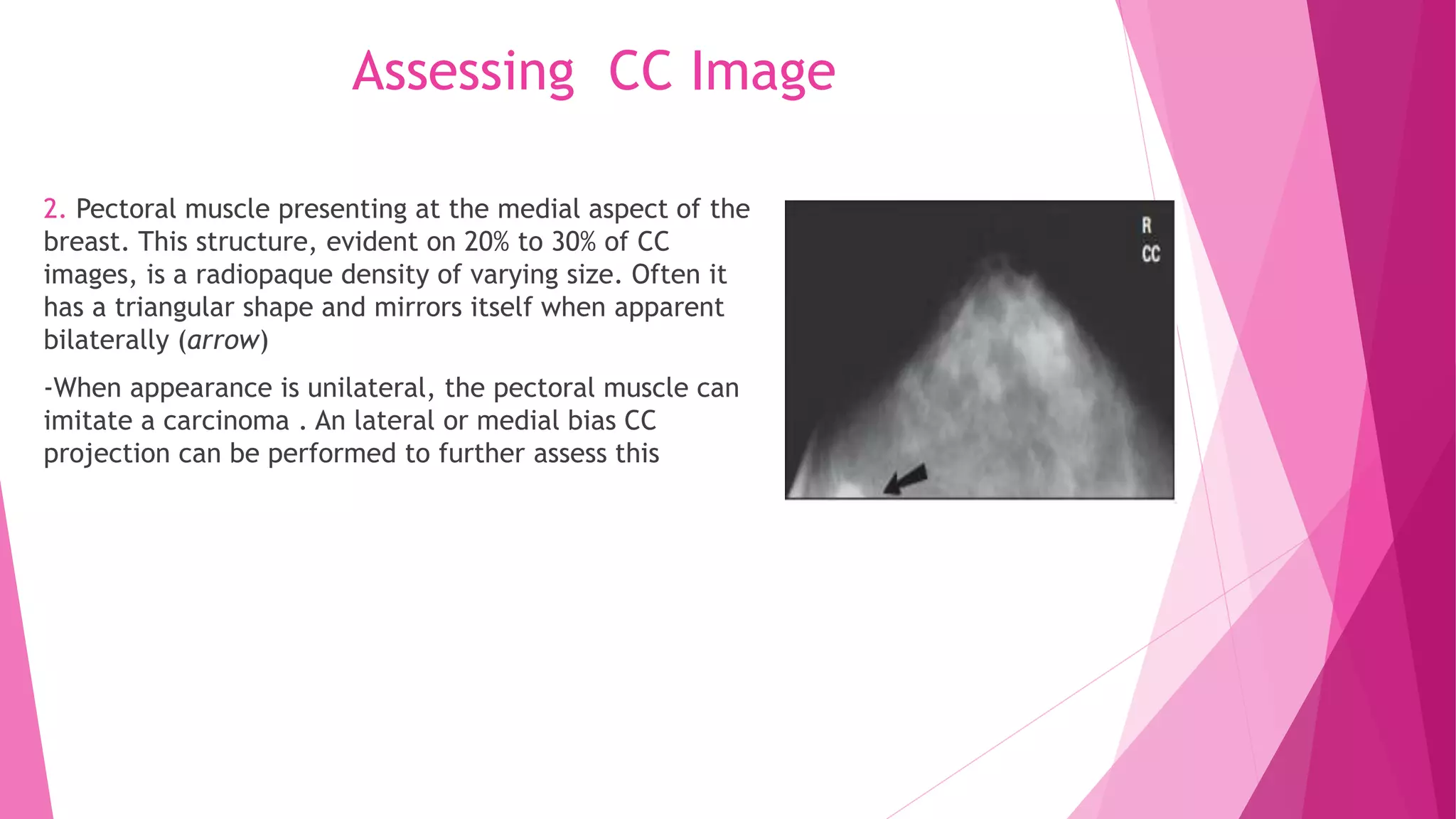 Mammography positioning technique for Cranio Caudal (CC) | PPTX
