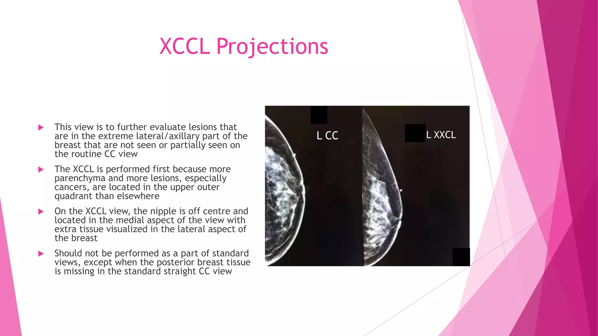Mammography positioning technique for Cranio Caudal (CC) | PPTX