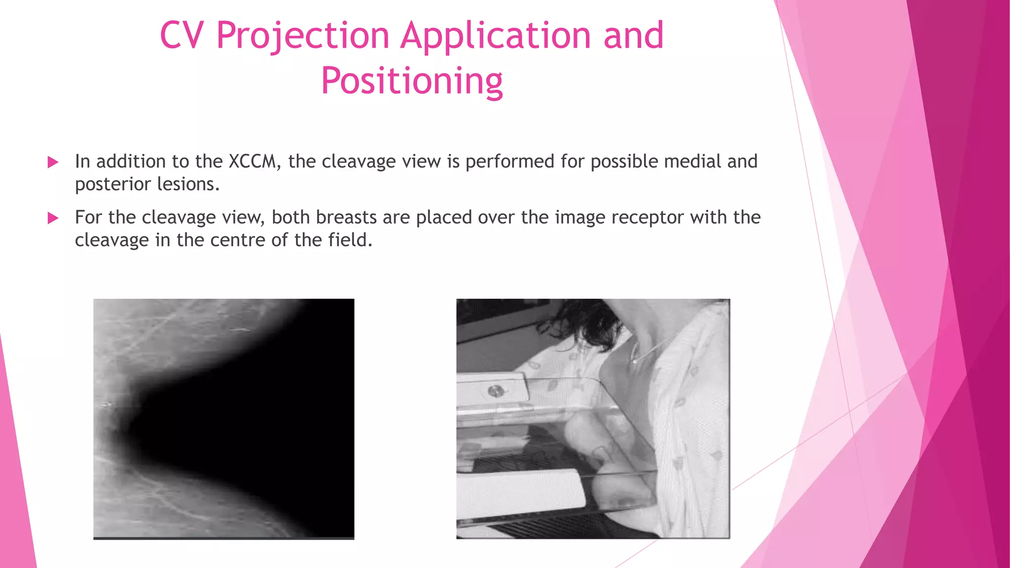 Mammography positioning technique for Cranio Caudal (CC) | PPTX