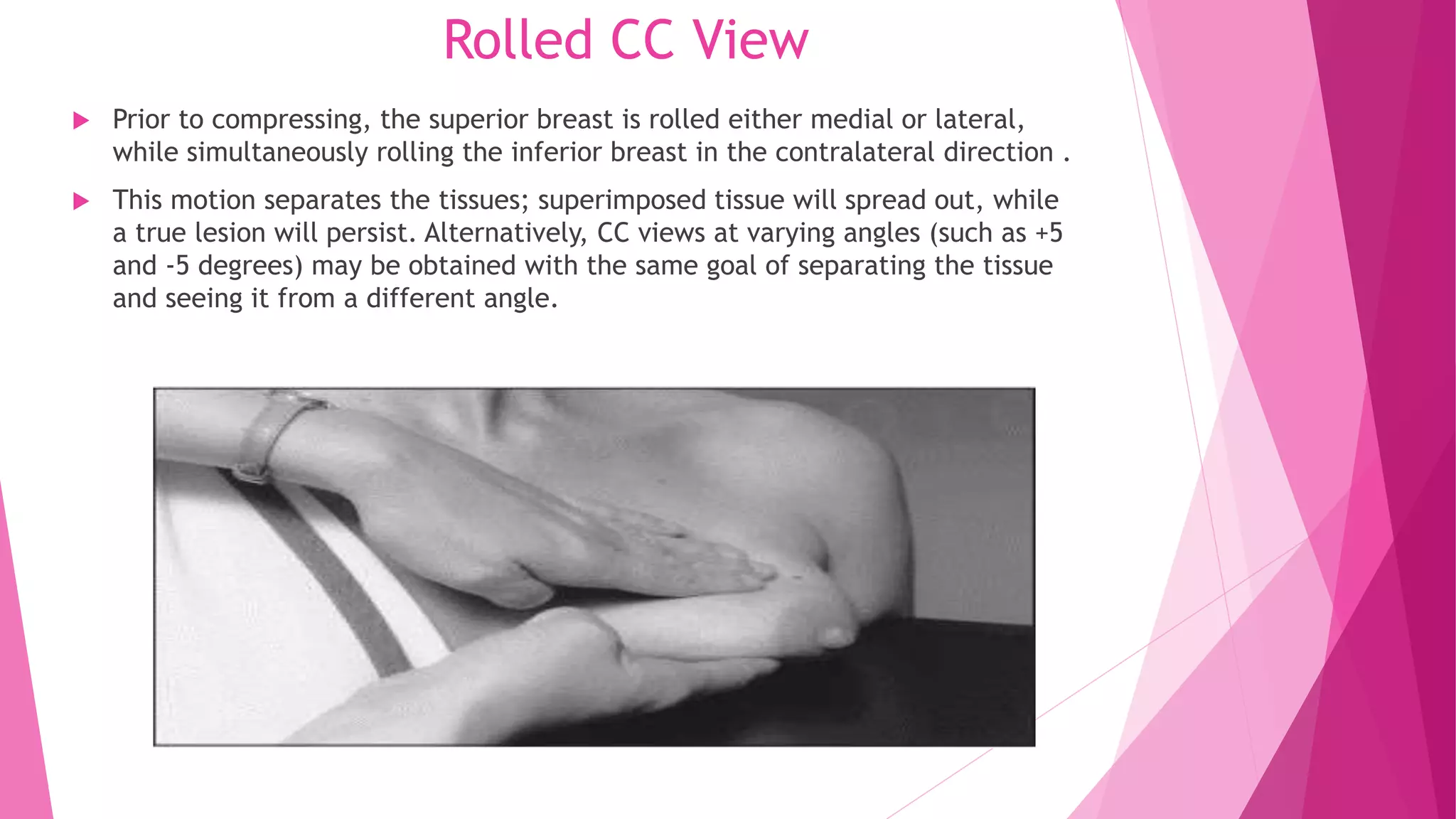 Mammography positioning technique for Cranio Caudal (CC) | PPTX