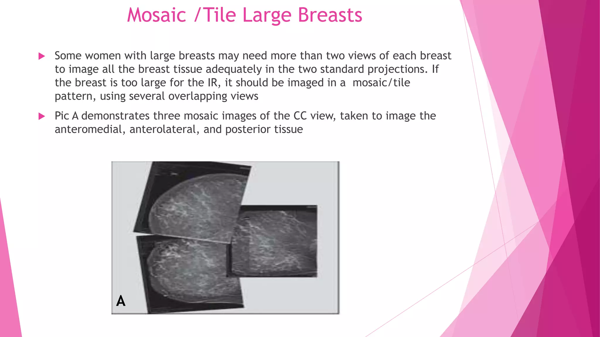 Mammography positioning technique for Cranio Caudal (CC) | PPTX