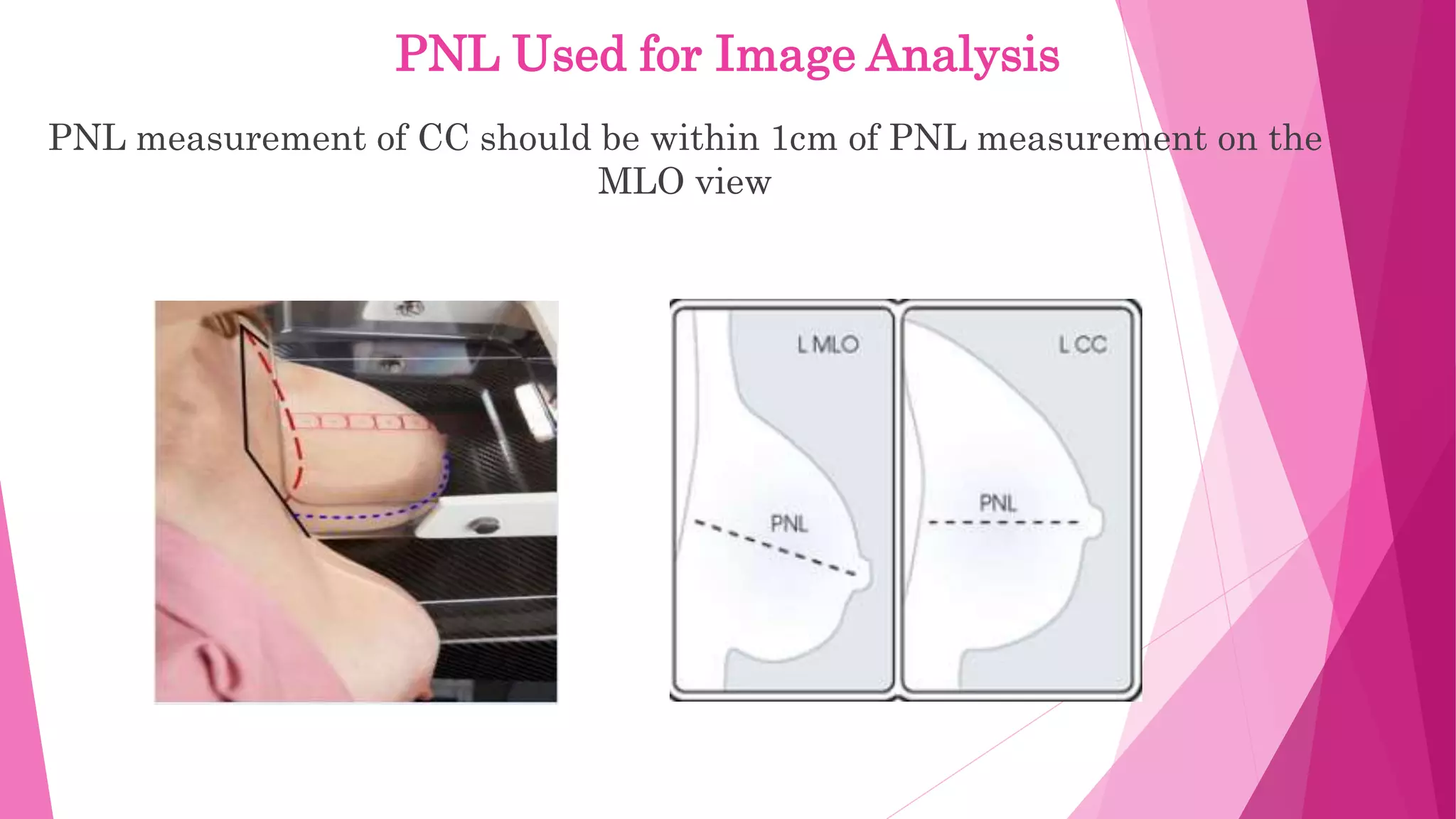 Mammography positioning technique for Cranio Caudal (CC) | PPTX