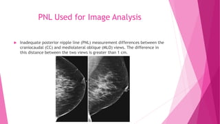 Mammography positioning technique for Cranio Caudal (CC) | PPTX