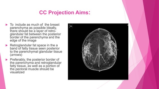 Mammography positioning technique for Cranio Caudal (CC) | PPTX