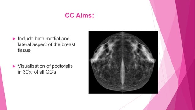 Mammography positioning technique for Cranio Caudal (CC) | PPTX