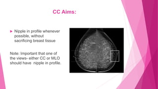 Mammography positioning technique for Cranio Caudal (CC) | PPTX