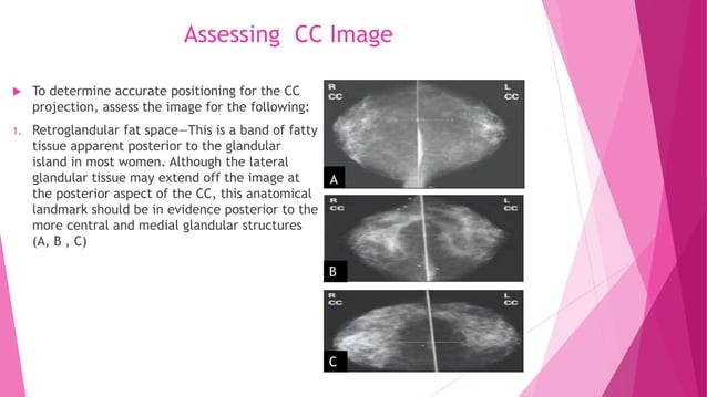 Mammography positioning technique for Cranio Caudal (CC) | PPTX