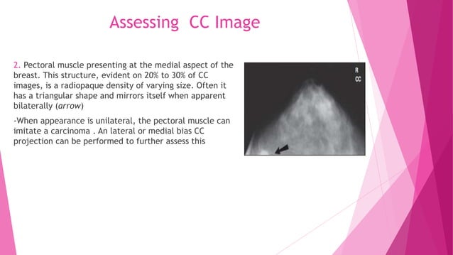 Mammography positioning technique for Cranio Caudal (CC) | PPTX