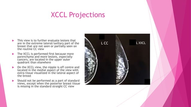 Mammography positioning technique for Cranio Caudal (CC) | PPTX