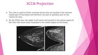 Mammography positioning technique for Cranio Caudal (CC) | PPTX