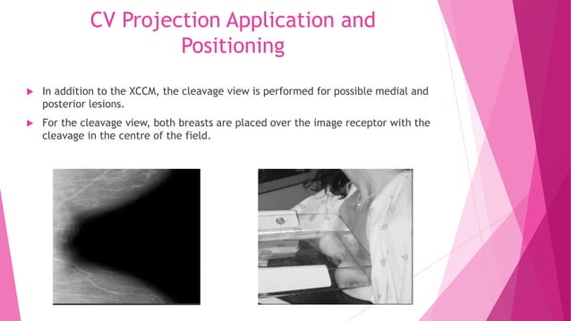 Mammography positioning technique for Cranio Caudal (CC) | PPTX