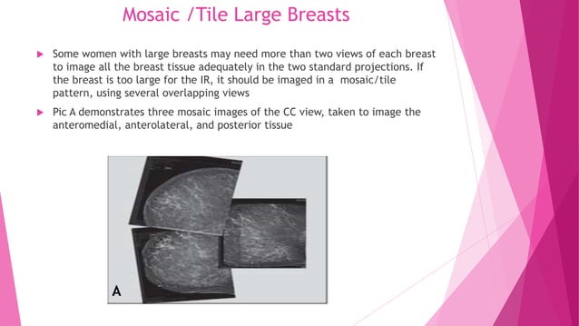 Mammography positioning technique for Cranio Caudal (CC) | PPTX