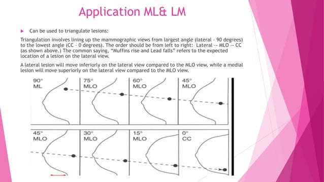 Mammography positioning technique for Lateral Views (LM/ML) | PPTX ...