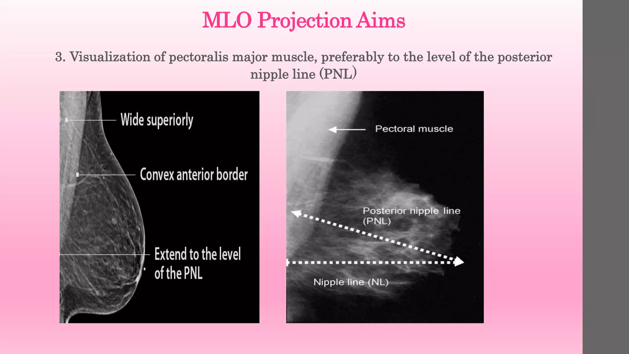 Mammography positioning technique for MLO View | PPTX