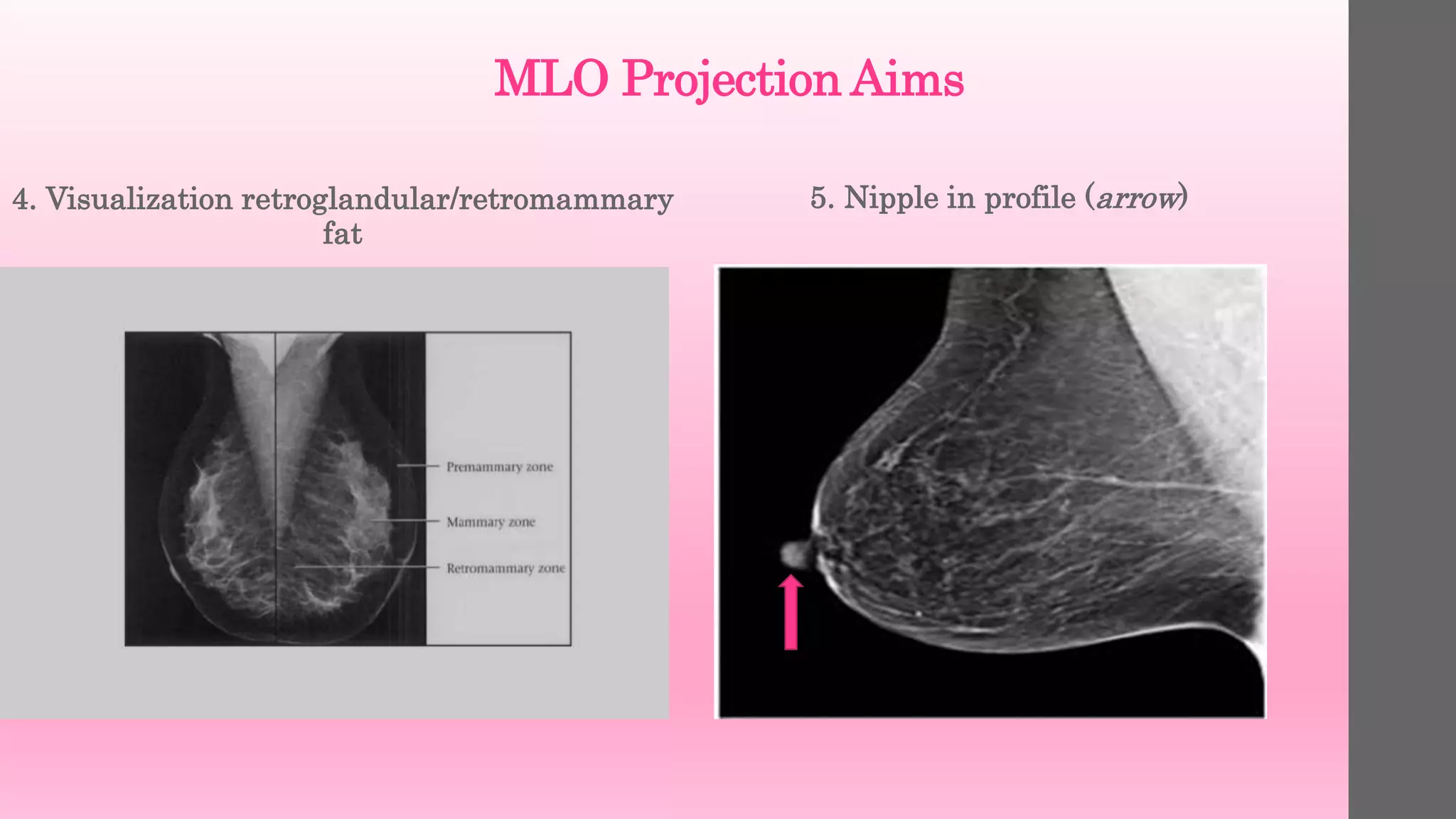 Mammography positioning technique for MLO View | PPTX