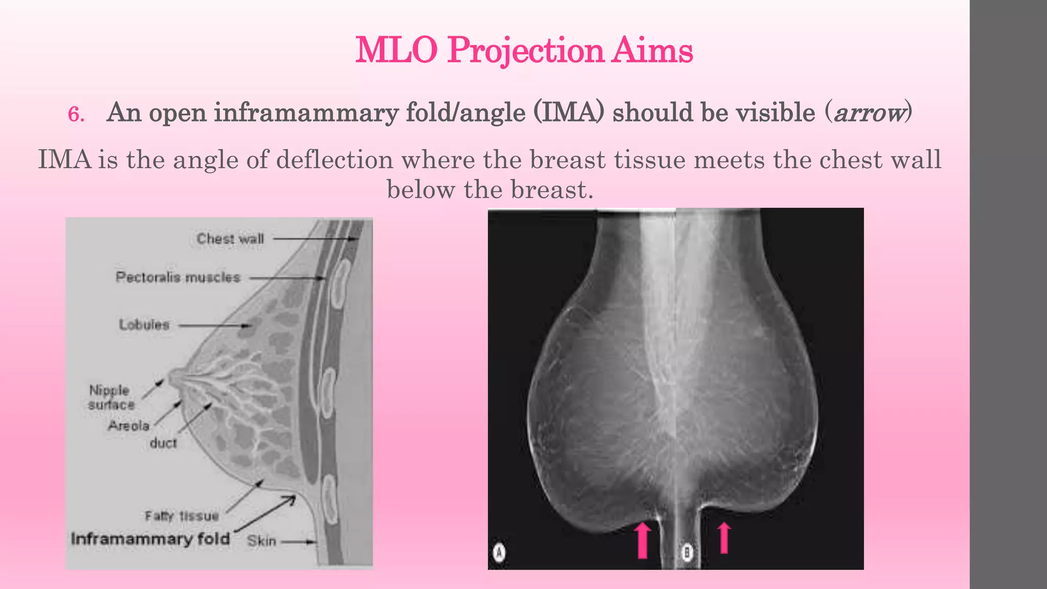 Mammography positioning technique for MLO View | PPTX