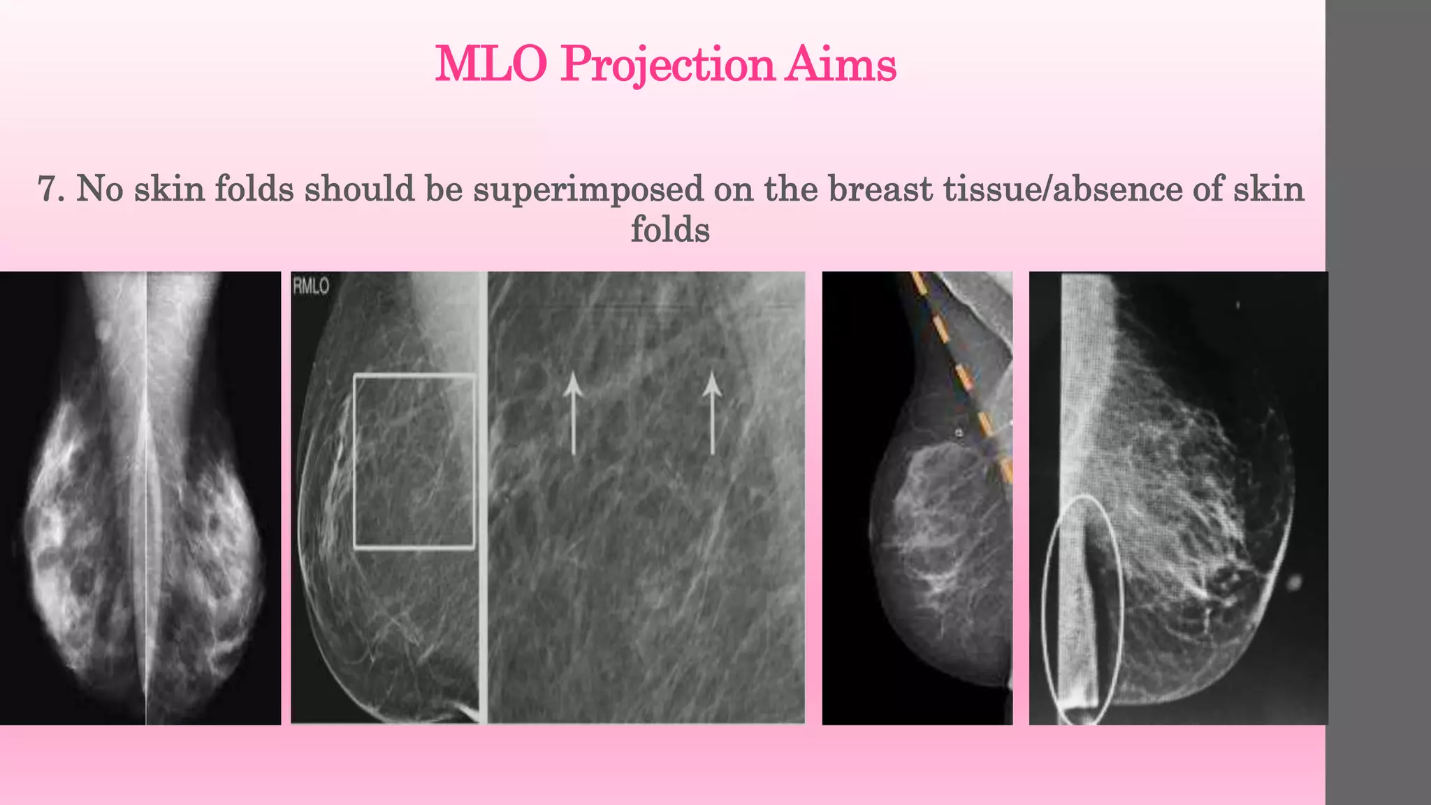 Mammography positioning technique for MLO View | PPTX