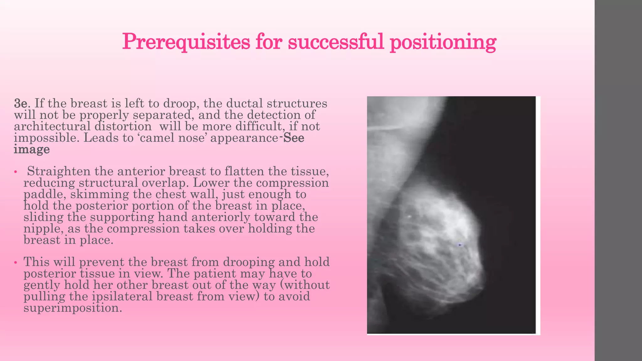 Mammography positioning technique for MLO View | PPTX