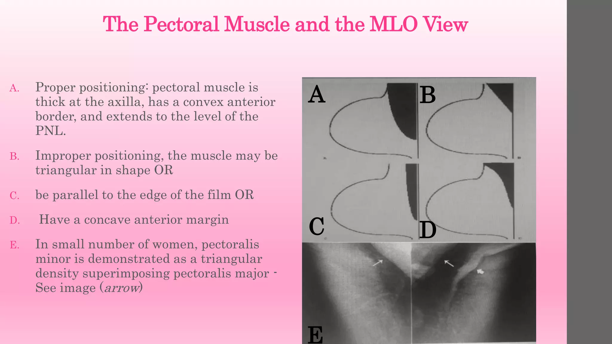 Mammography positioning technique for MLO View | PPTX