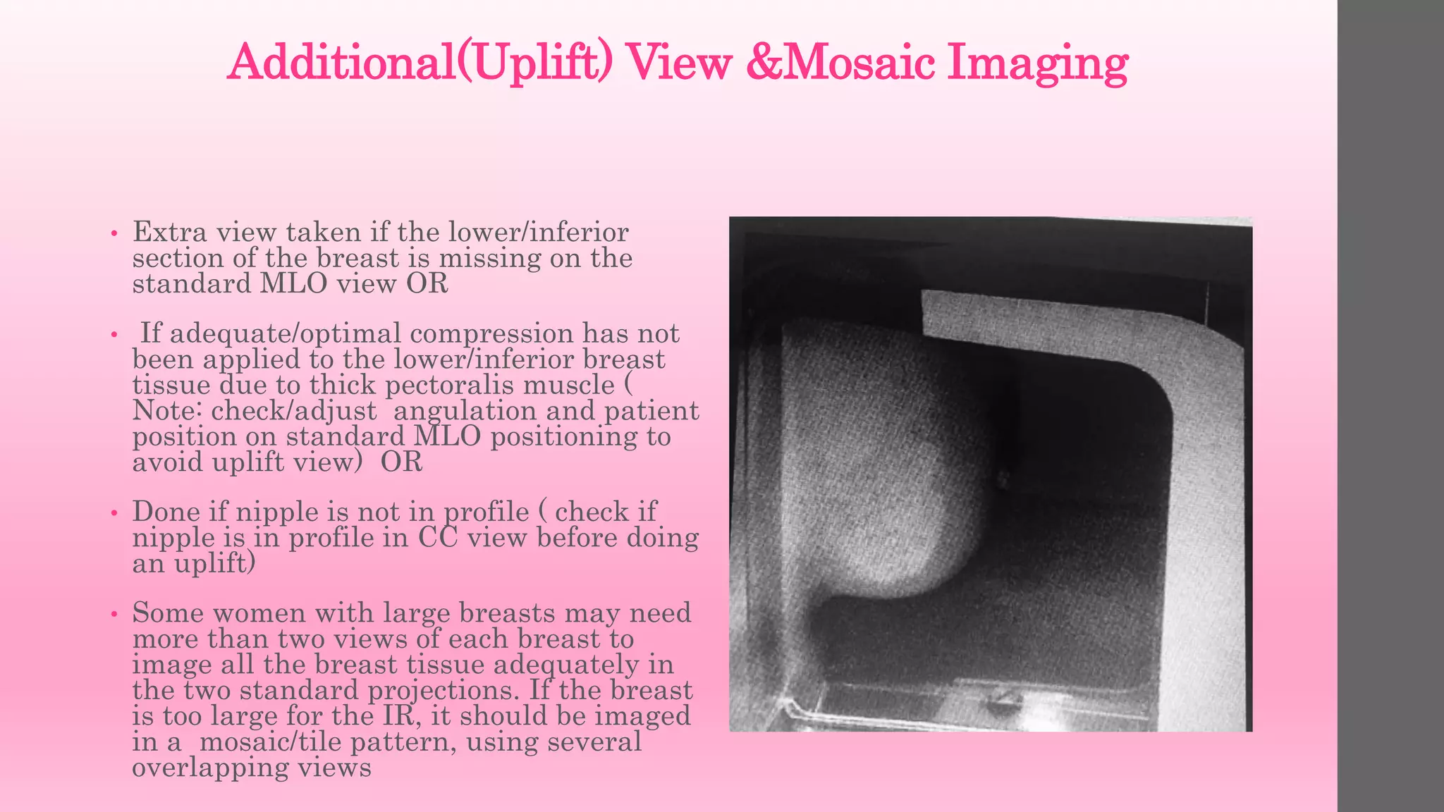 Mammography positioning technique for MLO View | PPTX
