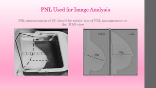 Mammography positioning technique for MLO View | PPTX